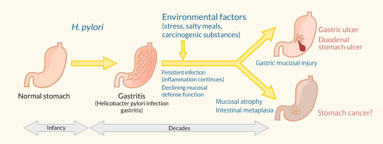 Diseases Caused By H Pylori Otsuka Pharmaceutical Co Ltd Diseases Caused By H Pylori Otsuka Pharmaceutical Co Ltd